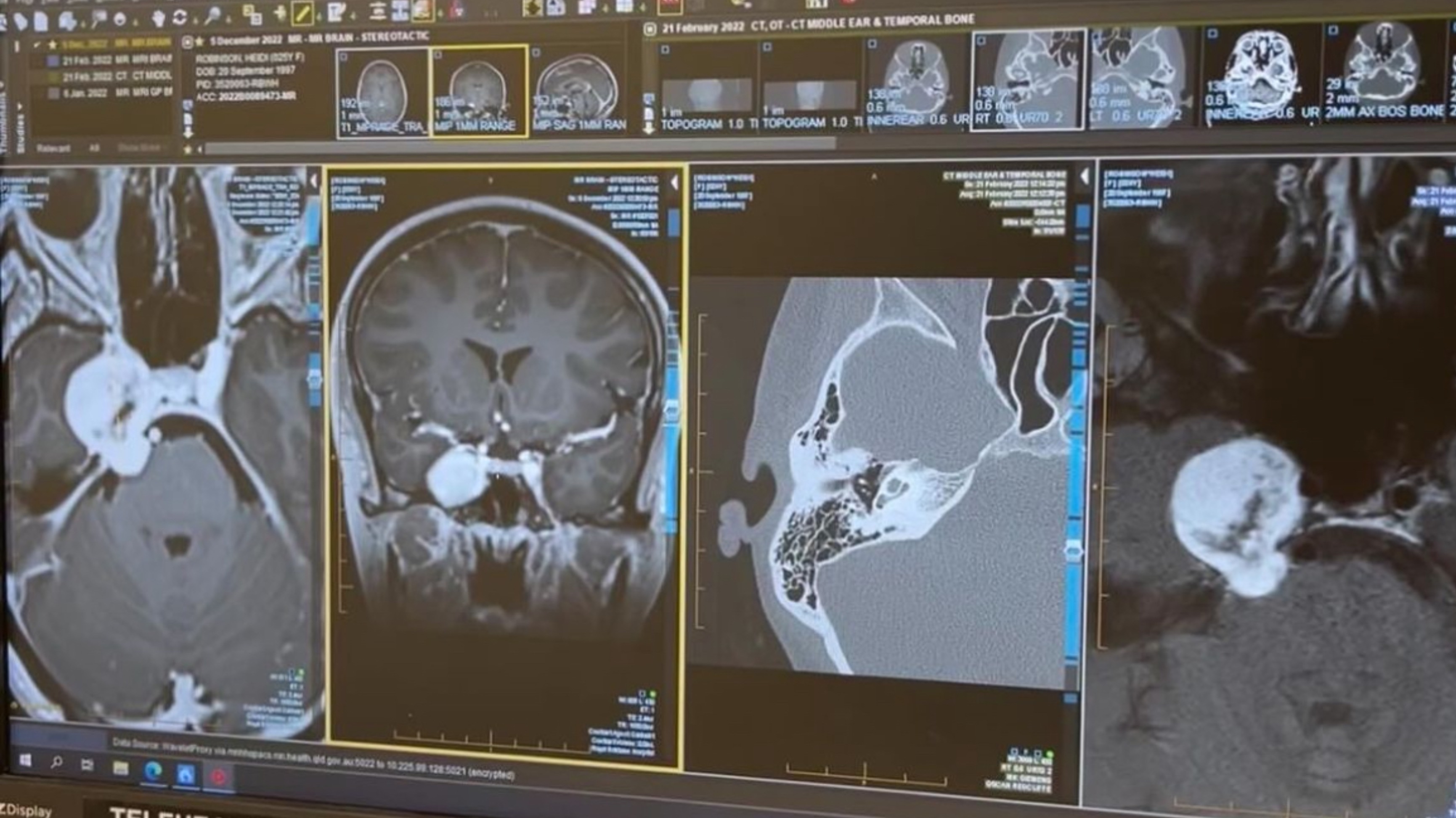 Brain Tumour removal surgery | Chuffed | Non-profit charity and social ...