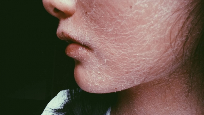 Help ITSAN: raising awareness for Red Skin Syndrome | Chuffed | Non ...